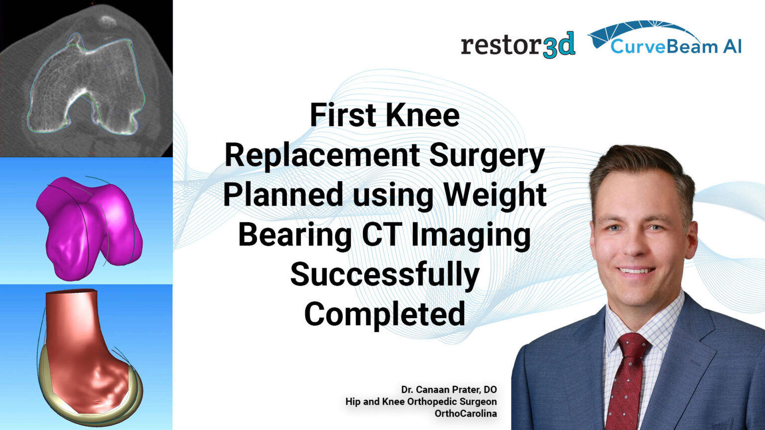 First Knee Replacement Surgery Planned with Weight Bearing CT Imaging ...