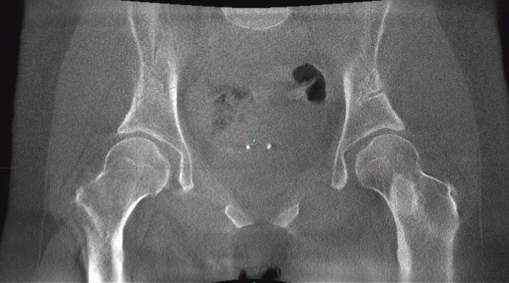 Weight Bearing CT for Hip & Knee Imaging - CurveBeam AI